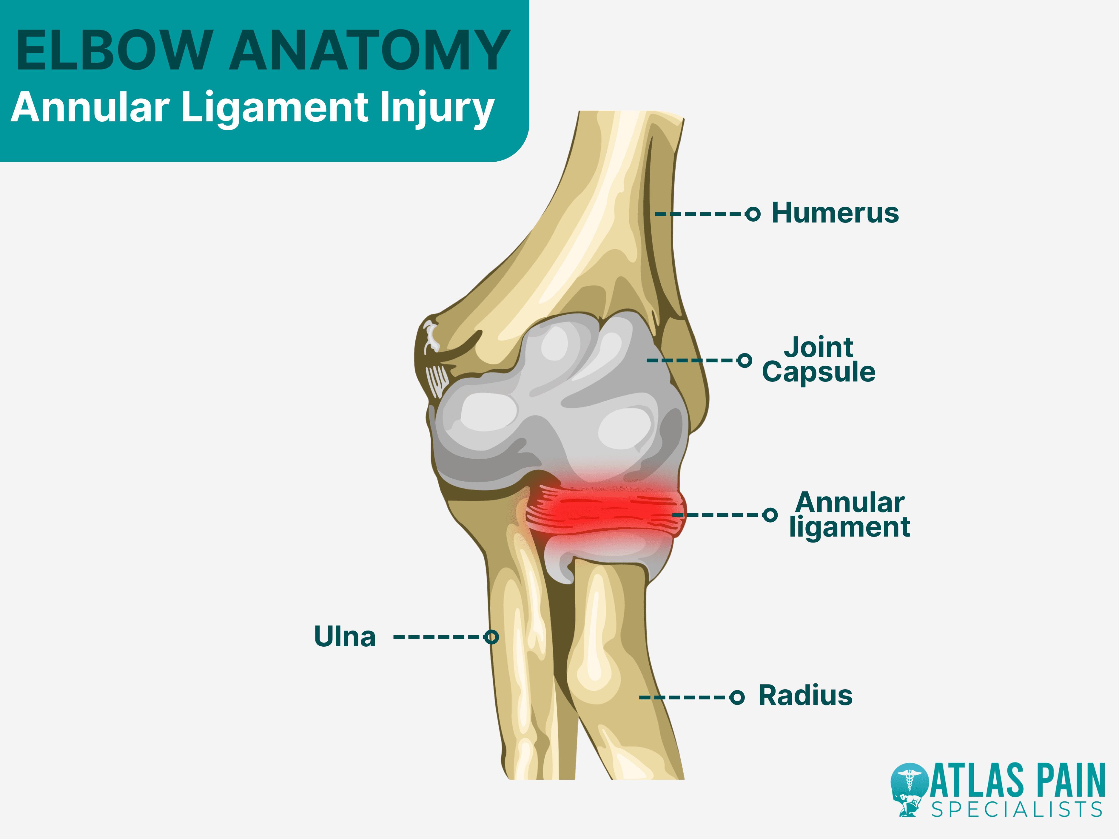 Annular Ligament Injury Symptoms - Atlas Pain Specialists