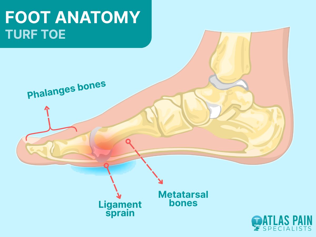 What Does Turf Toe Look Like? - Atlas Pain Specialists