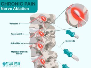 Nerve Ablation Costs: What You Need to Know Before Treatment