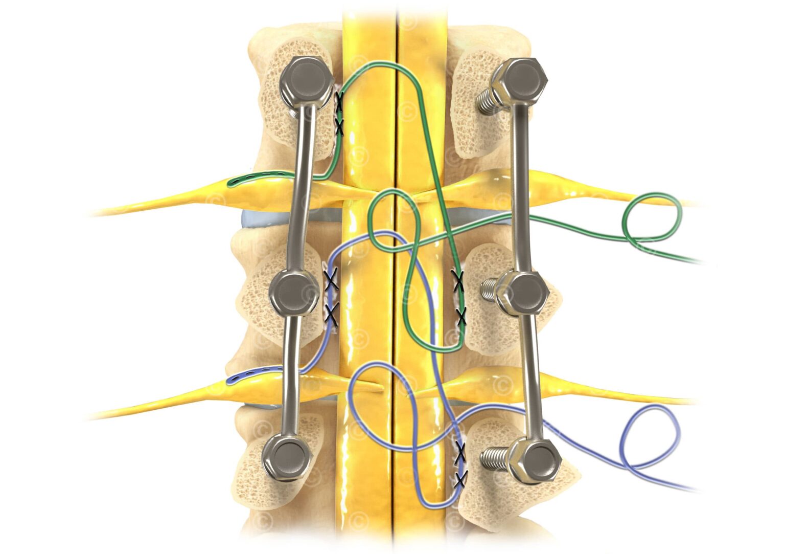 DRG Stimulation for Chronic Pain | Atlas Pain Specialists