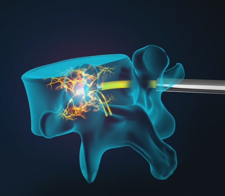 Intracept Procedure in Phoenix, AZ | Atlas Pain Specialists