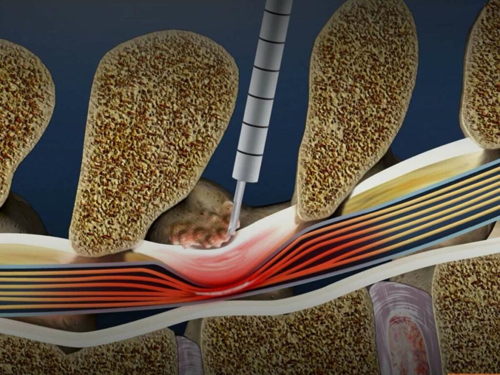 Mild® Procedure for Lumbar Spinal Stenosis in Phoenix, AZ