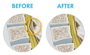 Mild® Procedure for Lumbar Spinal Stenosis in Phoenix, AZ